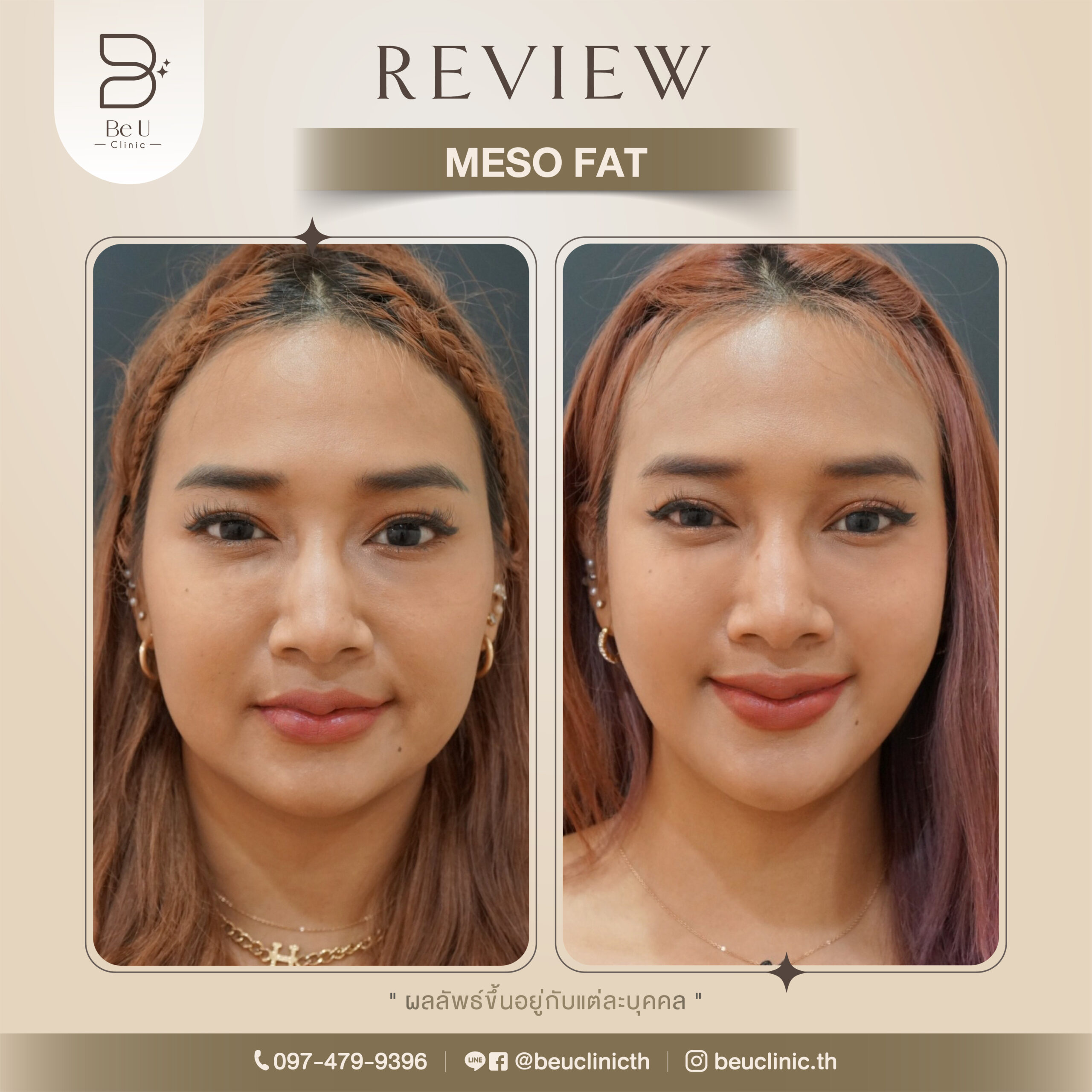 Meso Fat Premium Plus – Be U Clinic
